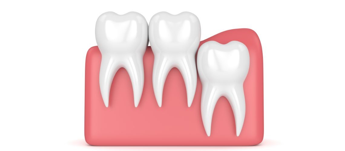 Wisdom Tooth Impacted or Infected: How To Know the Difference?
